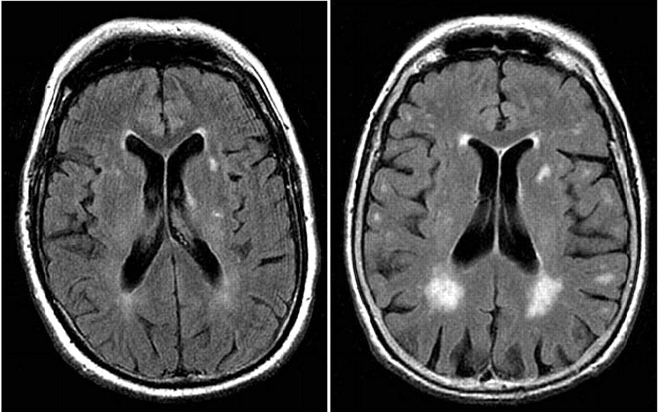 5 Minute Brain MRI Can Reveal Risk For Alzheimer s Disease